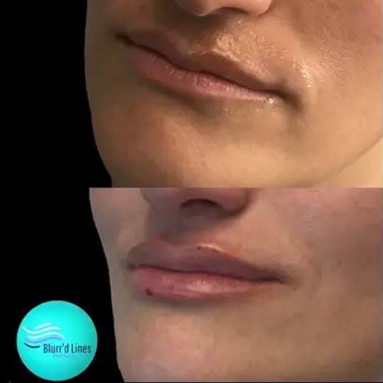 Patient Treatment Plan – Blurr’d Lines