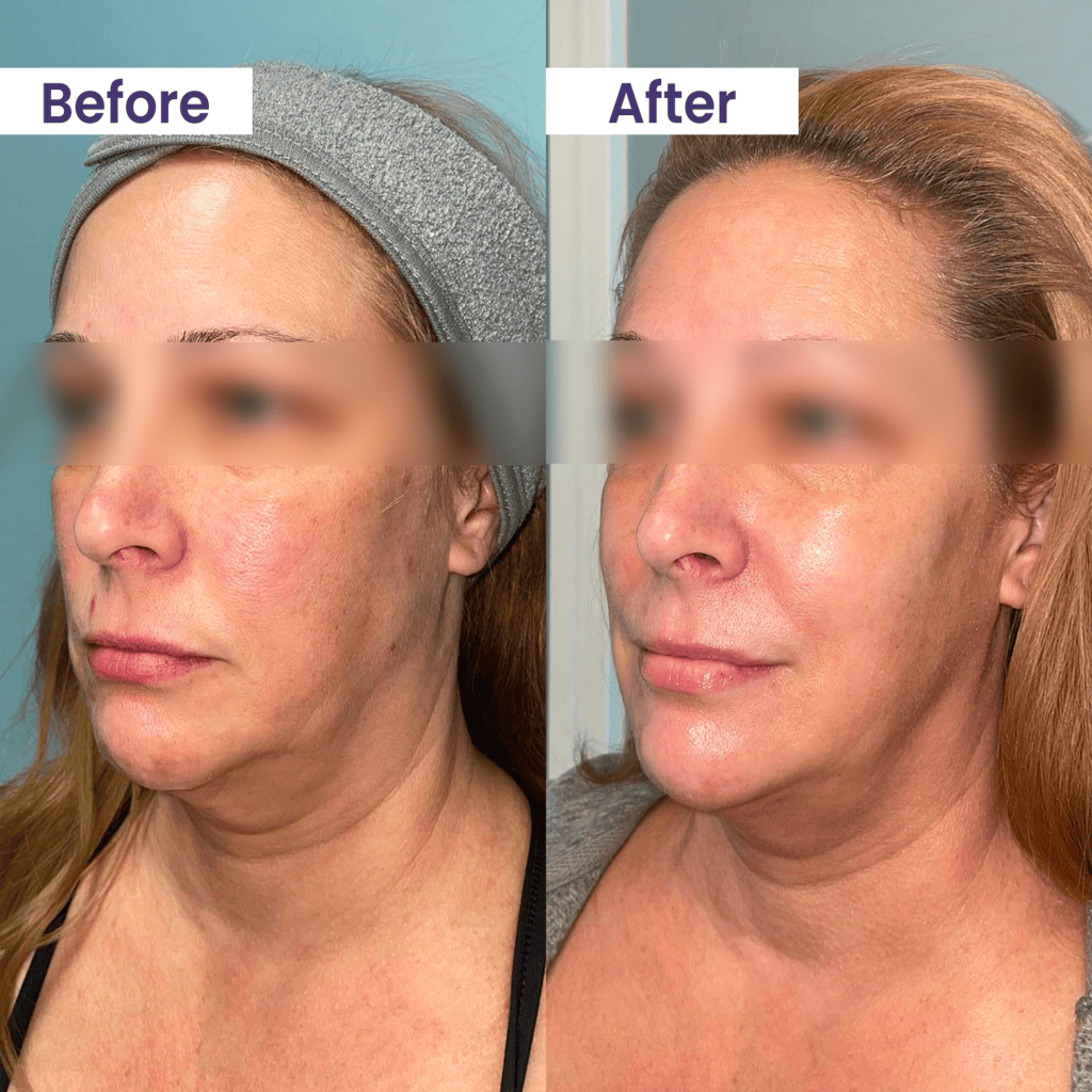 Medspa in Dartmouth, MA | Blurr’d Lines